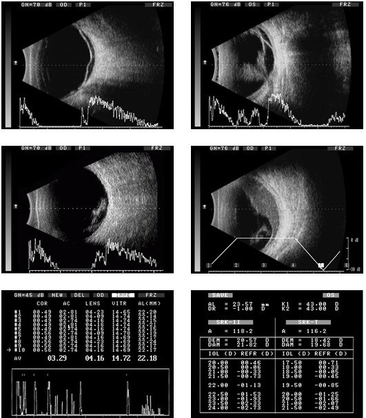 Ophthalmic Equipment Ab Scan (ODM-2100)